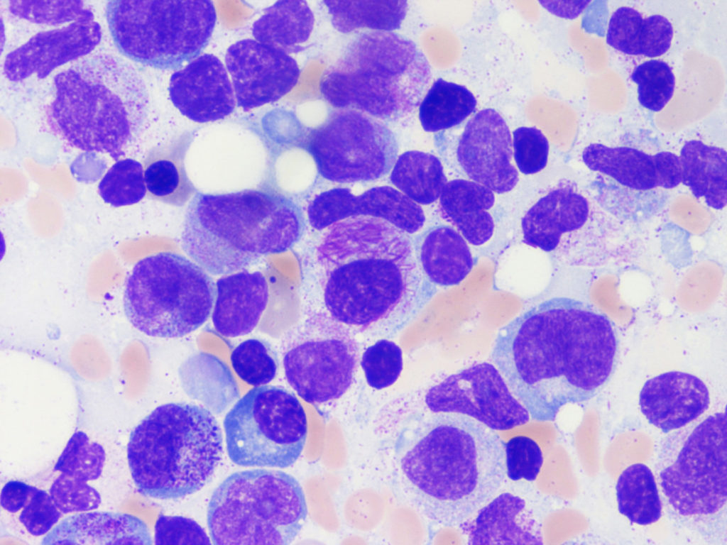 Lutte contre la leucémie - Traitement maladies du sang & leucémie ...