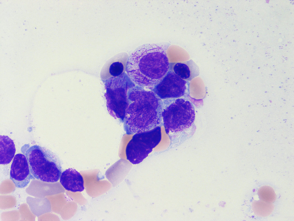 Lutte contre la leucémie - Traitement maladies du sang & leucémie ...